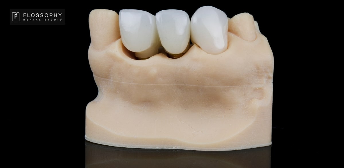 The Gap Between Your Dental Crown And Gums: How To Fix It?