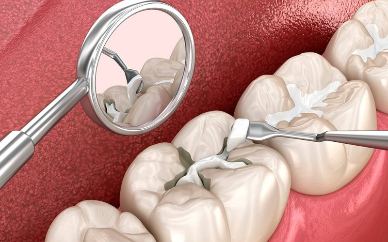 Tooth Fillings 101: Which Type Is Most Popular?